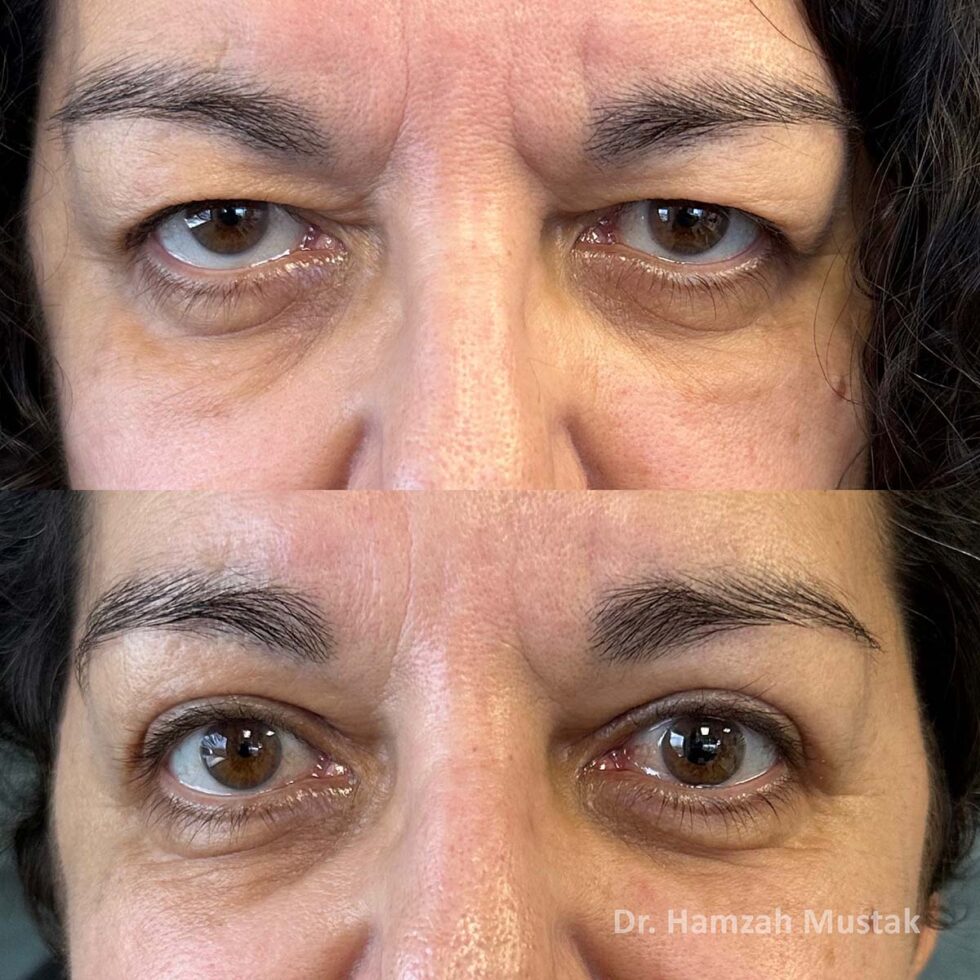 Droopy Eyelid (Ptosis) Treatment/Surgery Cape Town, South Africa