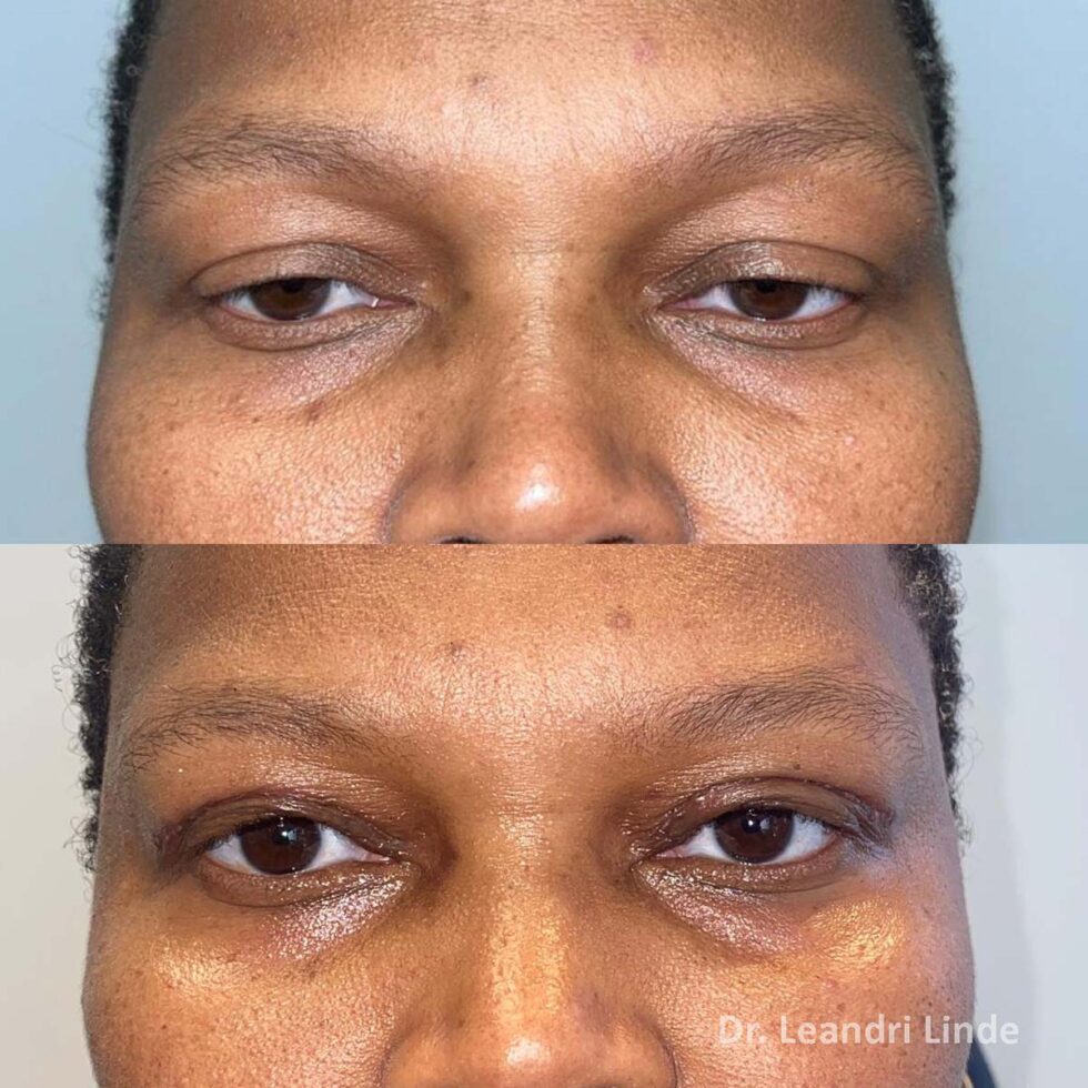 Droopy Eyelid (Ptosis) Treatment/Surgery Cape Town, South Africa